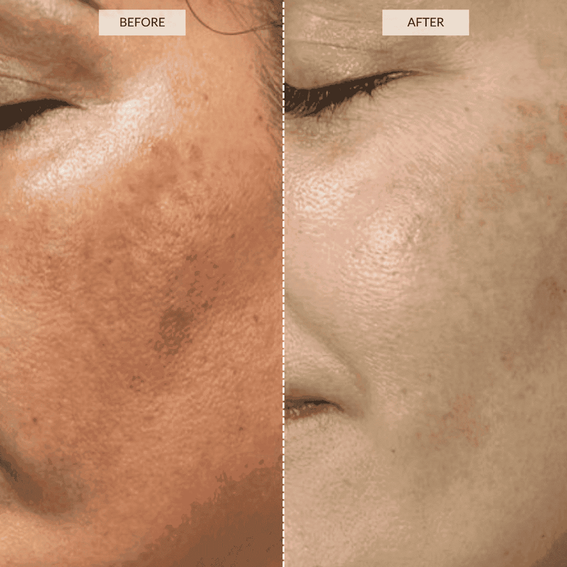 Dermalux Flex MD LED Light Therapy Device | CurrentBody Canada