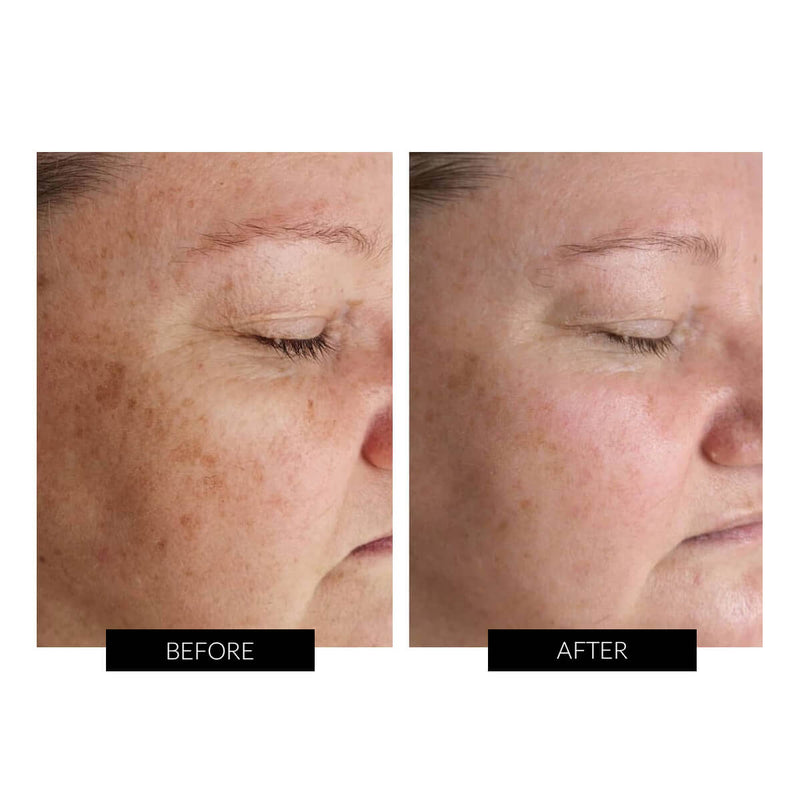 Dermalux Flex MD LED Light Therapy Device | CurrentBody Canada